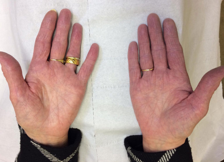Verruca Needling (Surgery) - Hand and Finger Warts - The Podiatry Clinic
